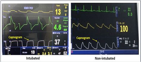 Capnography In The Nonintubated Patient Virtual Library
