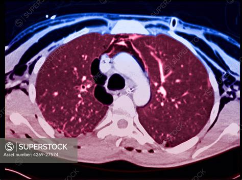Cutaneous Emphysema Axial Computed Tomography Ct Scan Of The Abdomen Showing Cutaneous
