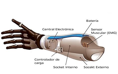 Prótesis Biónicas Bionix3d