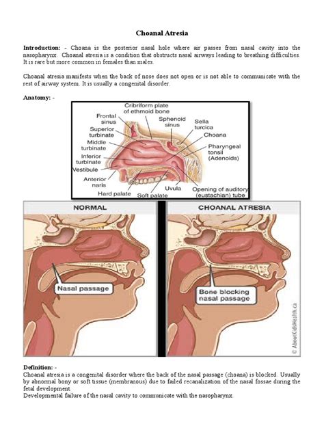 Choanal Atresia Pdf Diseases And Disorders Medical Specialties