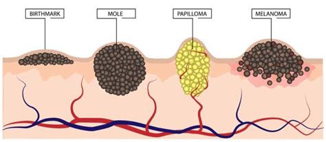 Moles Aim At Melanoma Foundation