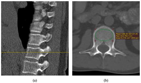 Osteoporosis X Ray Comparison