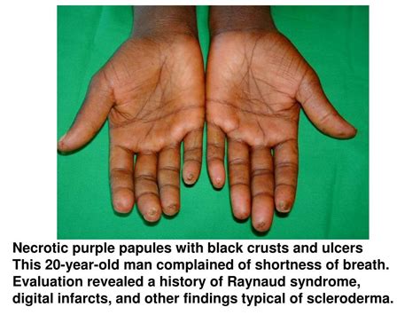 Ppt The Face In Diffuse Systemic Sclerosis Note The Radial Furrows Surrounding The Mouth