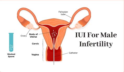 Iui For Male Infertility How Is It Useful In Treating Male Infertility