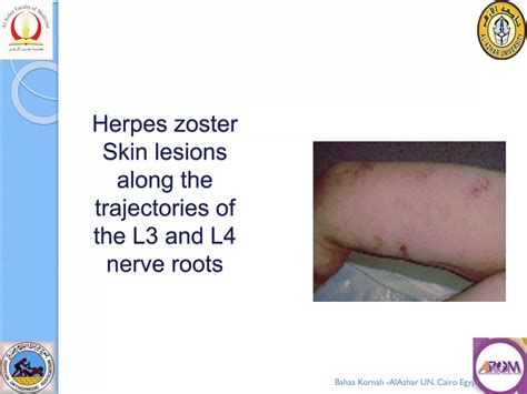 Extra Spinal Causes Of Sciatica And A Causes Algorithm Ppt