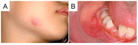 Dentoalveolar Abscess