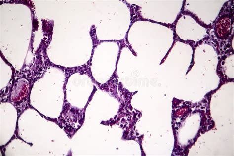 Pneumonia Light Micrograph Stock Image Image Of Medicine Histology 141006501