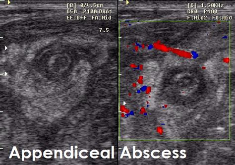 Management Of Acute Appendicitis Medicalopedia