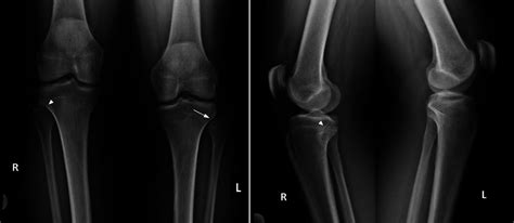 Proximal Tibiofibular Joint Dislocation Treated Using Flexible And