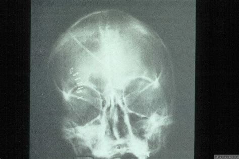 Maxillary Sinus Pptx Drwafaa Muhadharaty