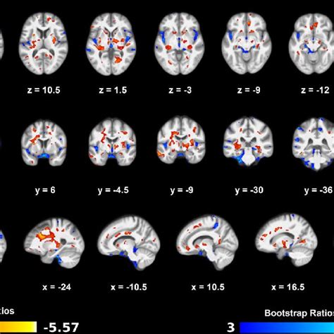 Brain Deformation Associated With The Brainstemcerebellum Pattern The