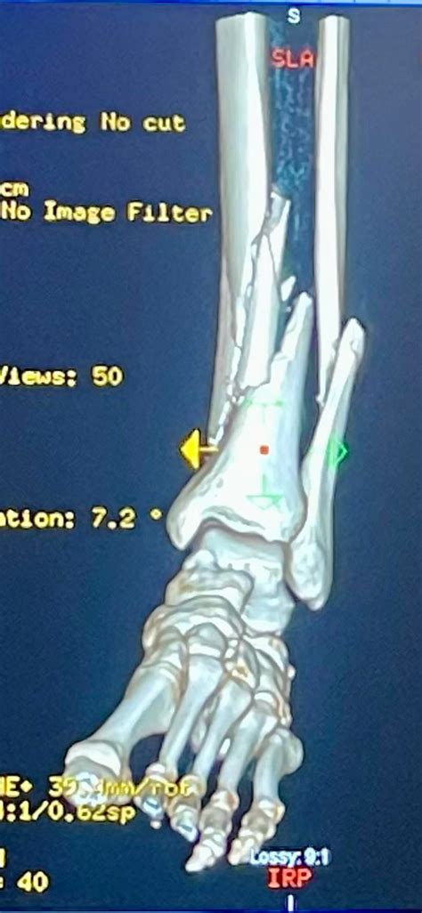 Broken Tibia 5 Times Fibula 1 Rbrokenbones