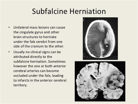 Neuro Critical Care