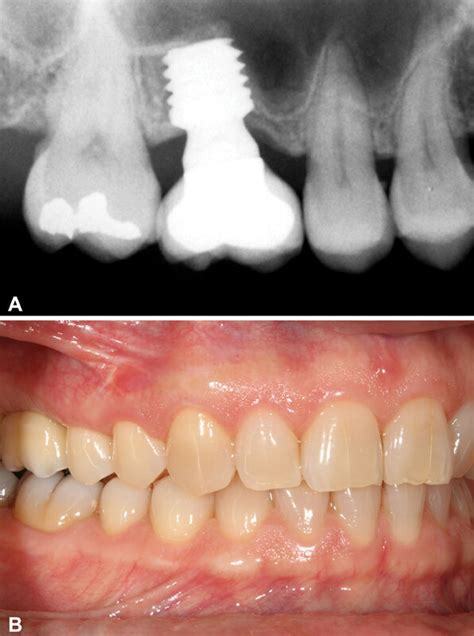Composition Panoramic Image And Clinical Image 1 Year After Implant
