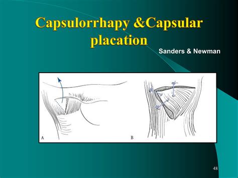 Tmj Dislocation And Its Management Pptx