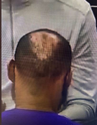 Photo Lebrons Scalp Doesnt Even Look Like Hes Balding Its More Like