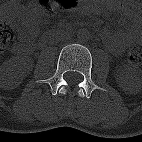 Normal Ct Lumbar Spine Radiopaedia 53981 60118 Axial Bone Window Nc