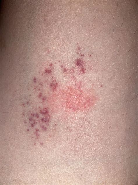 Rashred Spots Near Bite Rspiderbites