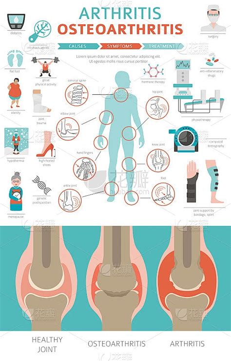 关节疾病。关节炎，骨关节炎症状，治疗图标设置。医疗信息图表设计素材 花瓣网