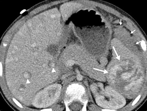 Angiosarcoma In A 6 Year Old Boy Axial Contrast Enhanced Ct Image