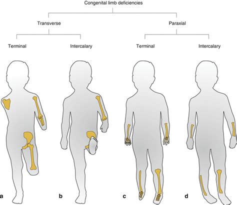 Congenital Limb Deficiency