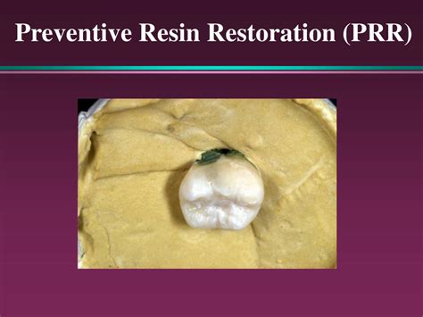 Ppt Class I And Ii Composite Restorations Principles And Techniques Powerpoint Presentation Id