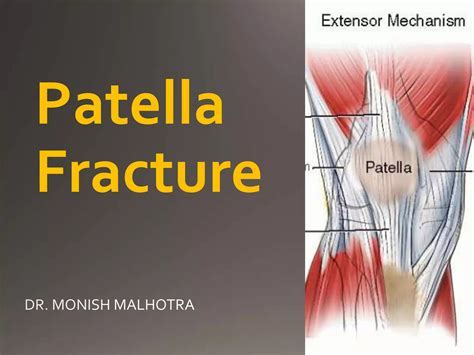 Patella Fracture Ppt