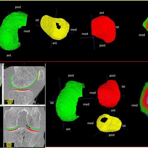 Examples Of Cartilage Segmentations For Both Sr Micro Ct Images A And