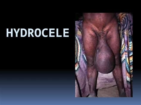 Hydrocele Complications And Its Management Pptx