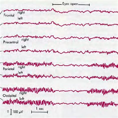 Eeg In A Normal Resting Awake Human The Recordings Were Made From Download Scientific Diagram