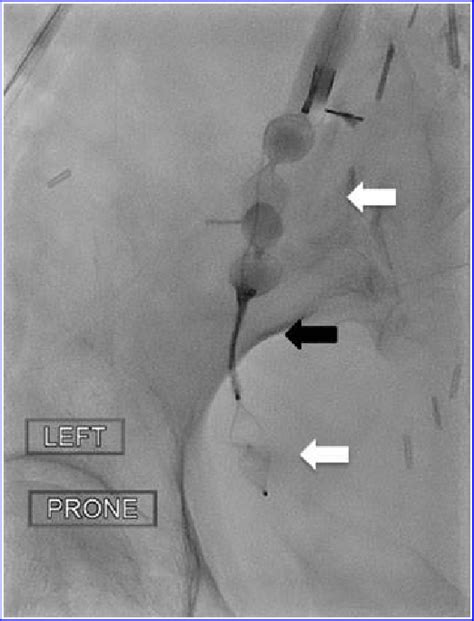 Fluoroscopy Image From A 79 Year Old Woman Who Presented With Download Scientific Diagram