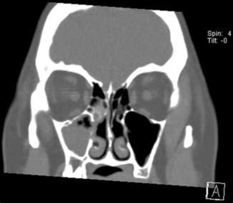What Do Sinus Polyps Look Like On A Ct Scan At Kasey Bailey Blog