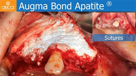 2 Phase Total Maxillary Rehabilitation With Bone Reconstruction And An