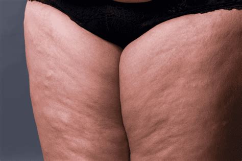 Lipedema Vs Cellulite Whats The Difference
