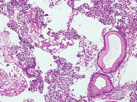 Pathology Outlines Gastrointestinal Stromal Tumor Gist