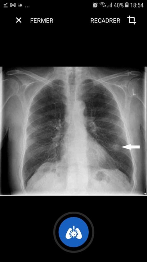 Artificial Intelligence App Locate Pulmonary Nodule And Help Doctors
