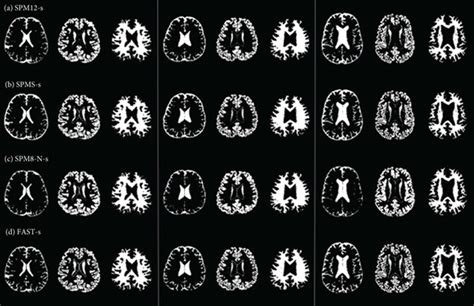Classification Of CSF GM And WM Tissues By Performing SPM S Download Scientific Diagram