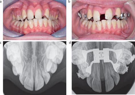 Hyrax Appliance Rapid Maxillary Expansion