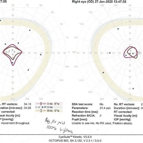 OCTOPUS Visual Fields Showing Severely Constricted Bilateral Fields Download Scientific