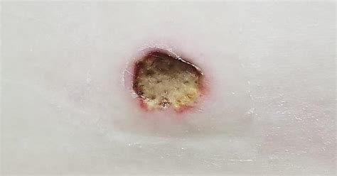 Sublocade Injection Reaction Album On Imgur