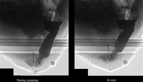 Defecographic Findings Of Circumferential Rectoanal Intussusception