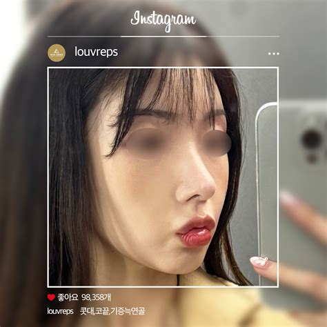 루브르성형외과 처음처럼 자연스럽게 전후사진후기셀카후기