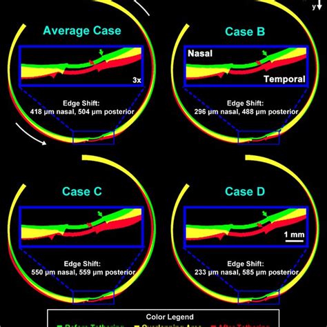 Horizontal Cross Sections Of Finite Element Model Superimposing Initial Download Scientific
