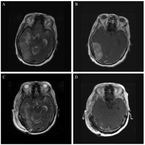 Resection Of Dural Based Brain Metastasis Pre And Postoperative Mri Download Scientific Diagram