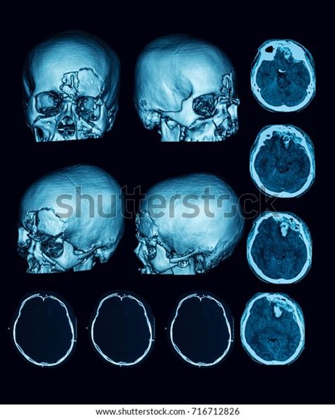 Ct Scan Multiple Fractures Skull Intracerebral库存照片716712826 Shutterstock