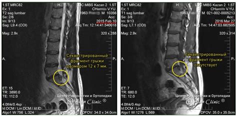 Остеохондроз поясничного отдела позвоночника ДО и ПОСЛЕ лечения