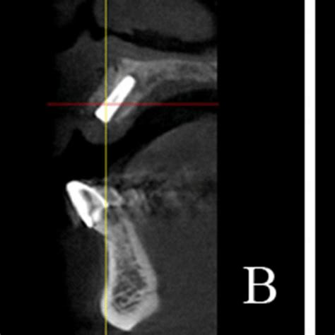 Pdf Horizontal Bone Augmentation And Simultaneous Implant Placement Using Xenogeneic Bone