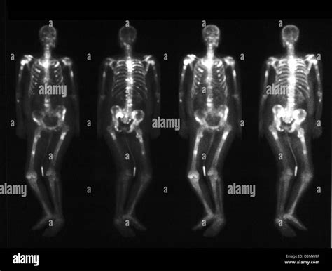Bone Scan Images