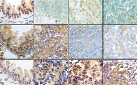 Researchers Identify Achilles Heel Of Pten That Helps Drive Prostate