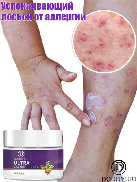 Dodoyuri Антипсориаз Крем мазь негормональный от псориаза экземы нейродермита грибковых
